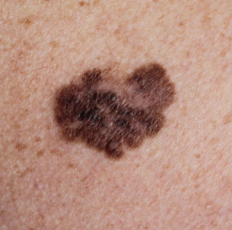 Mole Checks | Faciem Dermatology & Medical Clinic